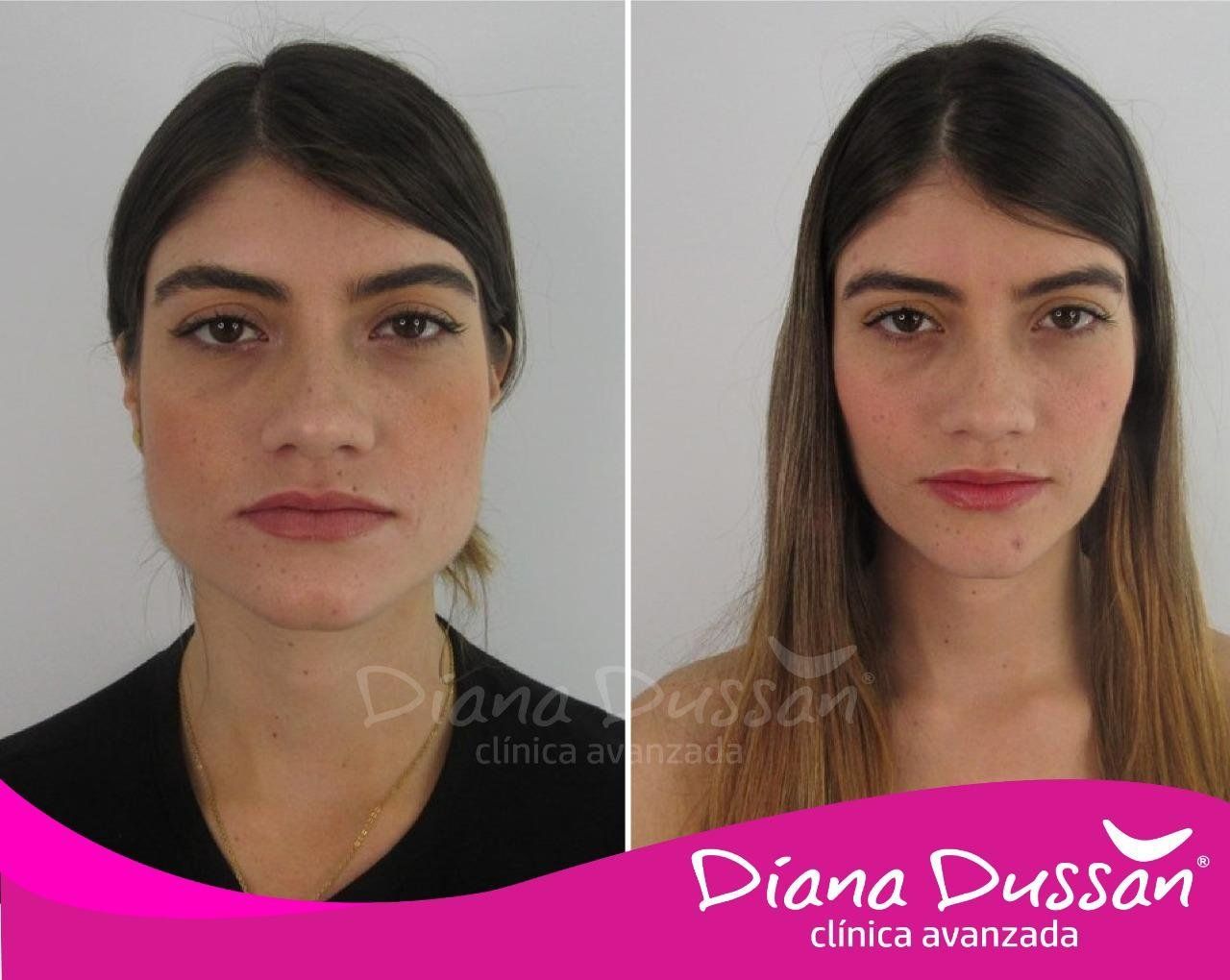 Toxina en musculos maseteros - Bótox - Clinicasesteticas.com.co