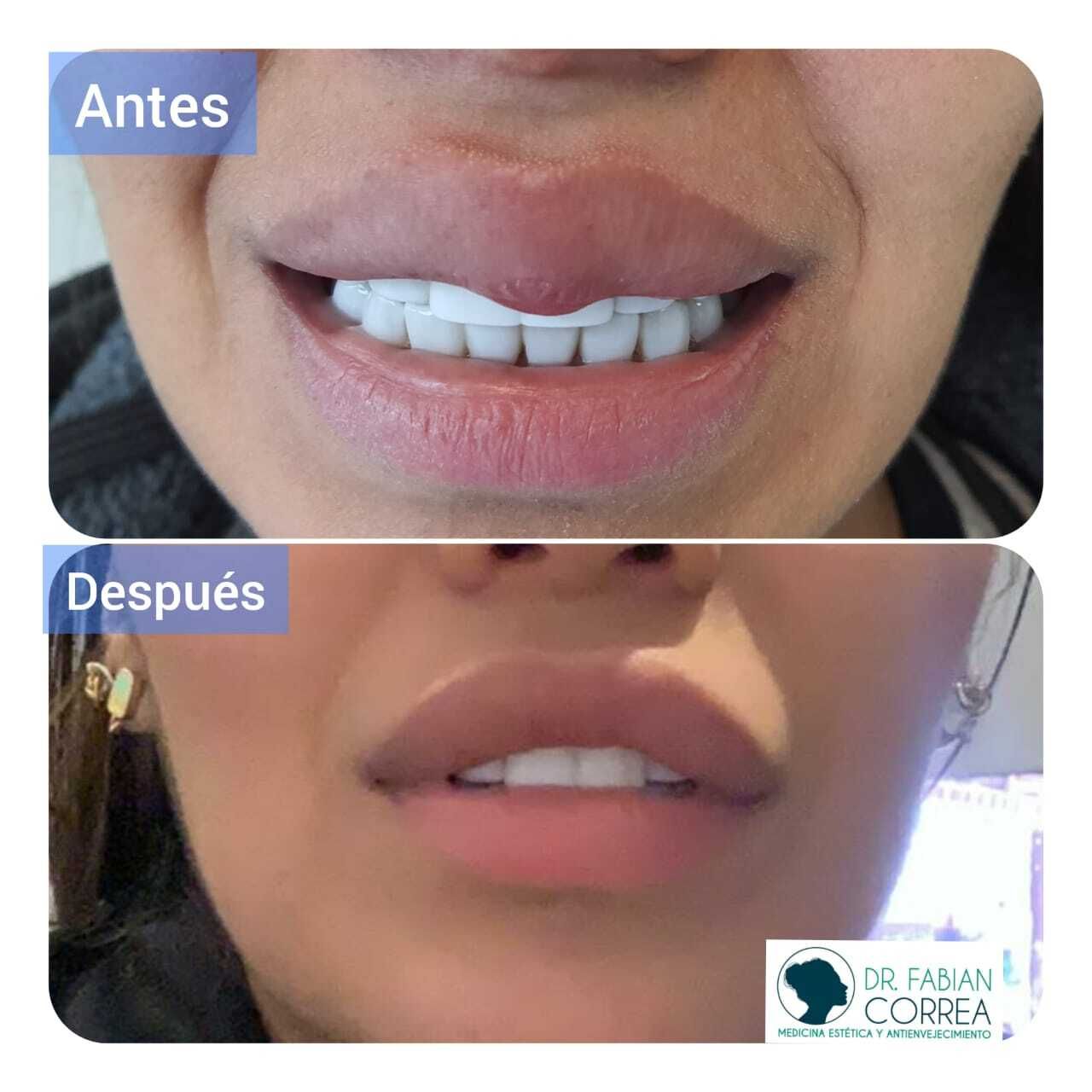 Reconstrucción De Labios Por Biopolímero 100 Satisfecha Con El Trabajo