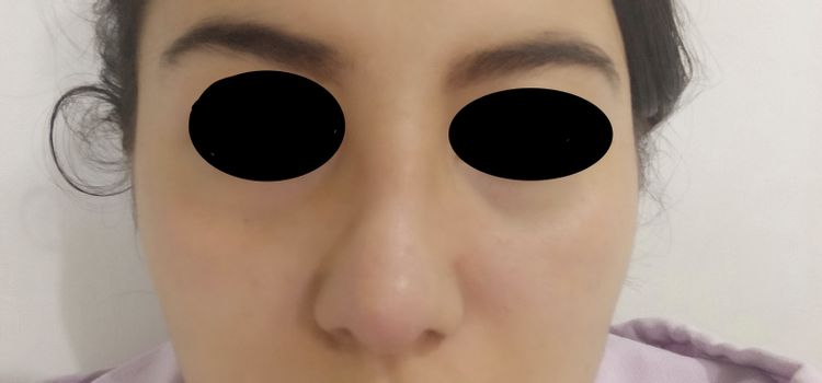 Corregir nariz desviada y fibrosis post rinoplastia - Clinicasesteticas ...